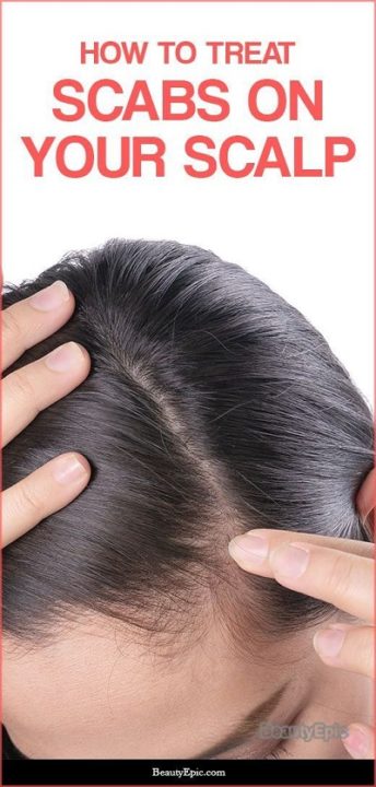 How To Get Rid Of Scabs On Scalp - What It Is, Causes And How To Treat