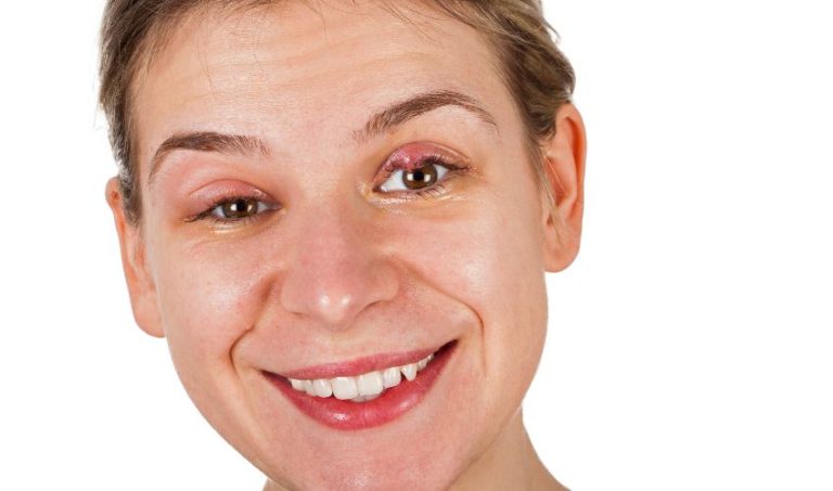 How To Get Rid Of A Stye: Home Remedies & Prevention