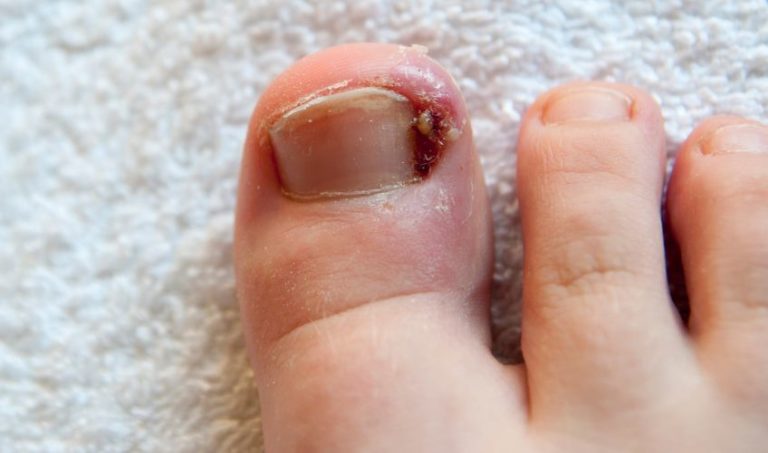 The 7 Best Remedies For Ingrown Toenails