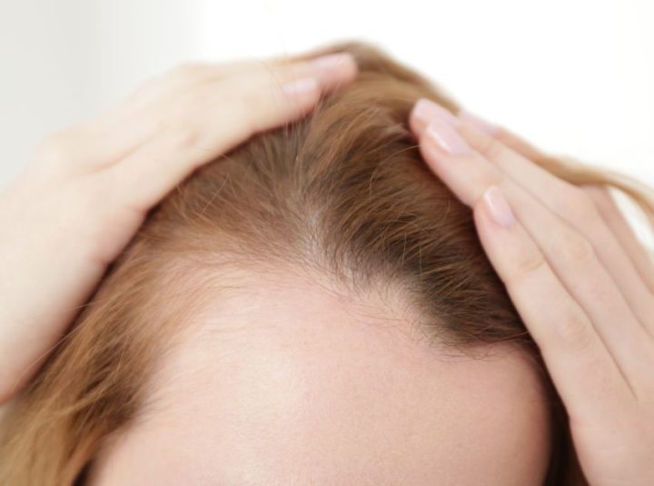 What Is A Cowlick And How To Fix It?