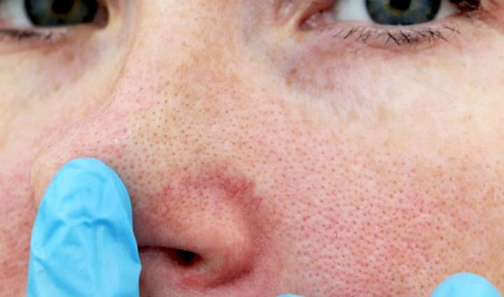 How To Get Rid Of Dry Skin Around The Nose