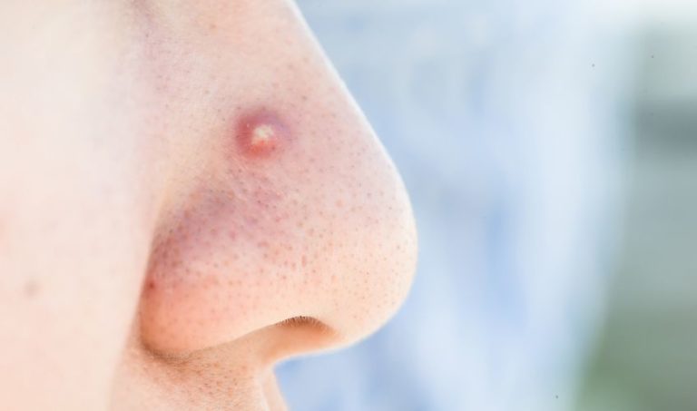 What Causes Red Spots On The Nose? And Treatment