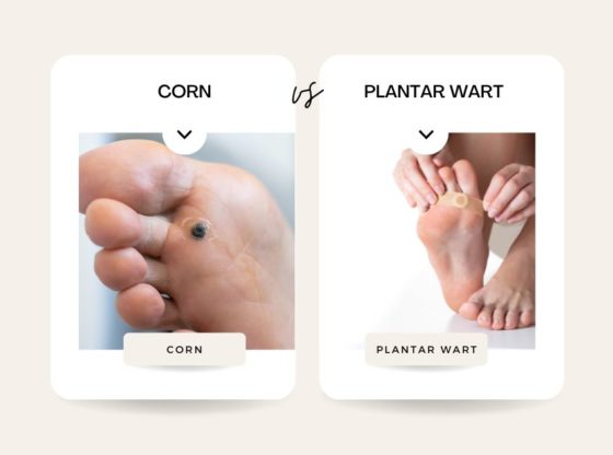 Plantar Wart Vs. Corn: What's The Difference?