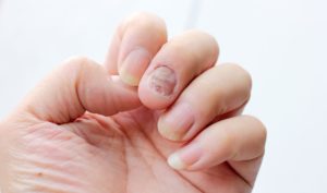 Nail Psoriasis Vs. Fungus: Know The Symptoms
