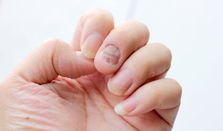 Nail Psoriasis Vs. Fungus: Know The Symptoms