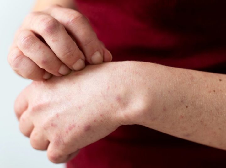 Can Cigarette Burns Leave Scars?