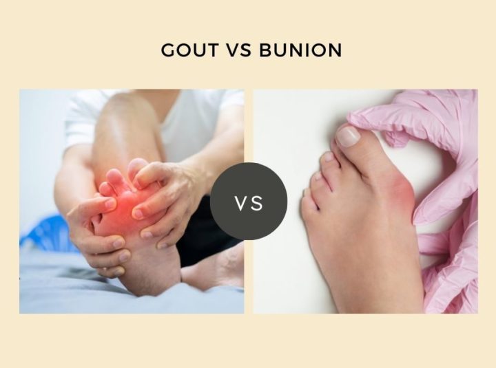 Bunion Vs. Gout: Identification, Diagnosis And Treatment