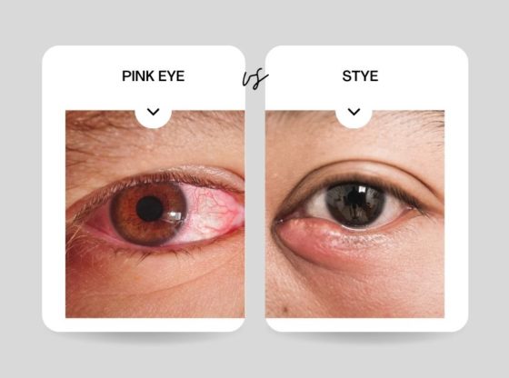 Pink Eye Vs. Stye: What's The Difference? Causes & Treatment